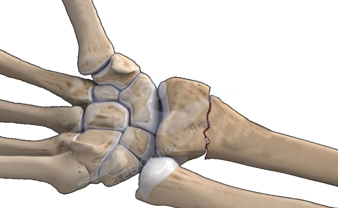 Orthopaedic & Trauma Surgeon - Wrist - Wrist fractures