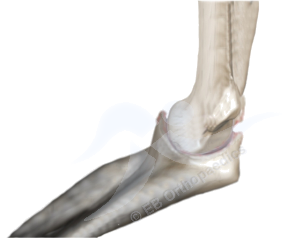 Orthopaedic & Trauma Surgeon - Elbow - Elbow arthritis