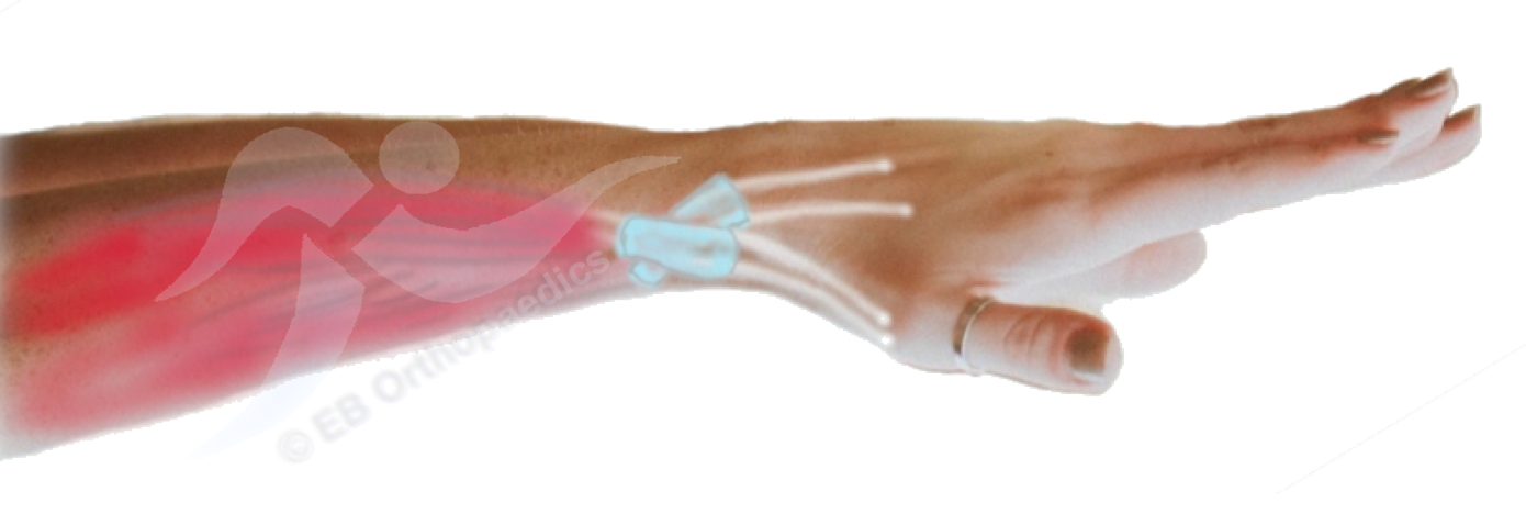Orthopaedic & Trauma Surgeon - Wrist - Intersection syndrome