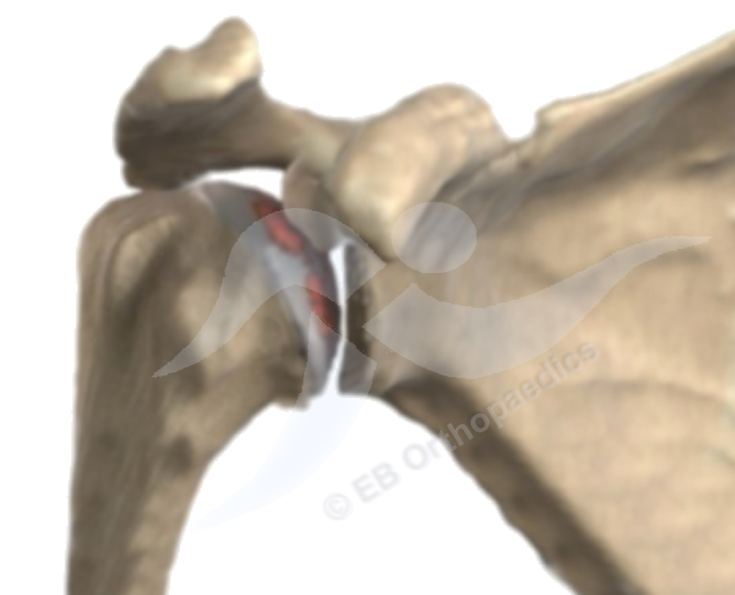 Orthopaedic & Trauma Surgeon - Shoulder - Shoulder arthritis