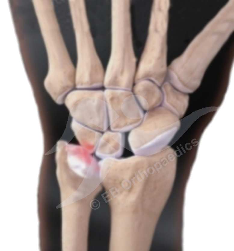 Orthopaedic & Trauma Surgeon - Wrist - Ulna abutment