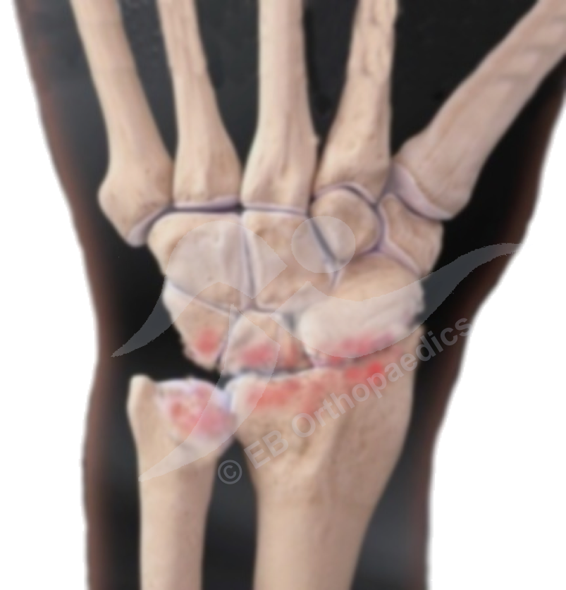 Osteoarthritis Wrist