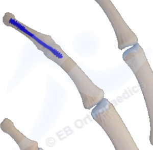 Physiotherapy Leaflets